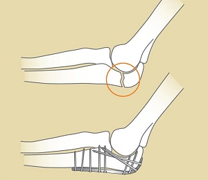 Elbow fractures: Causes, Symptoms & Treatment